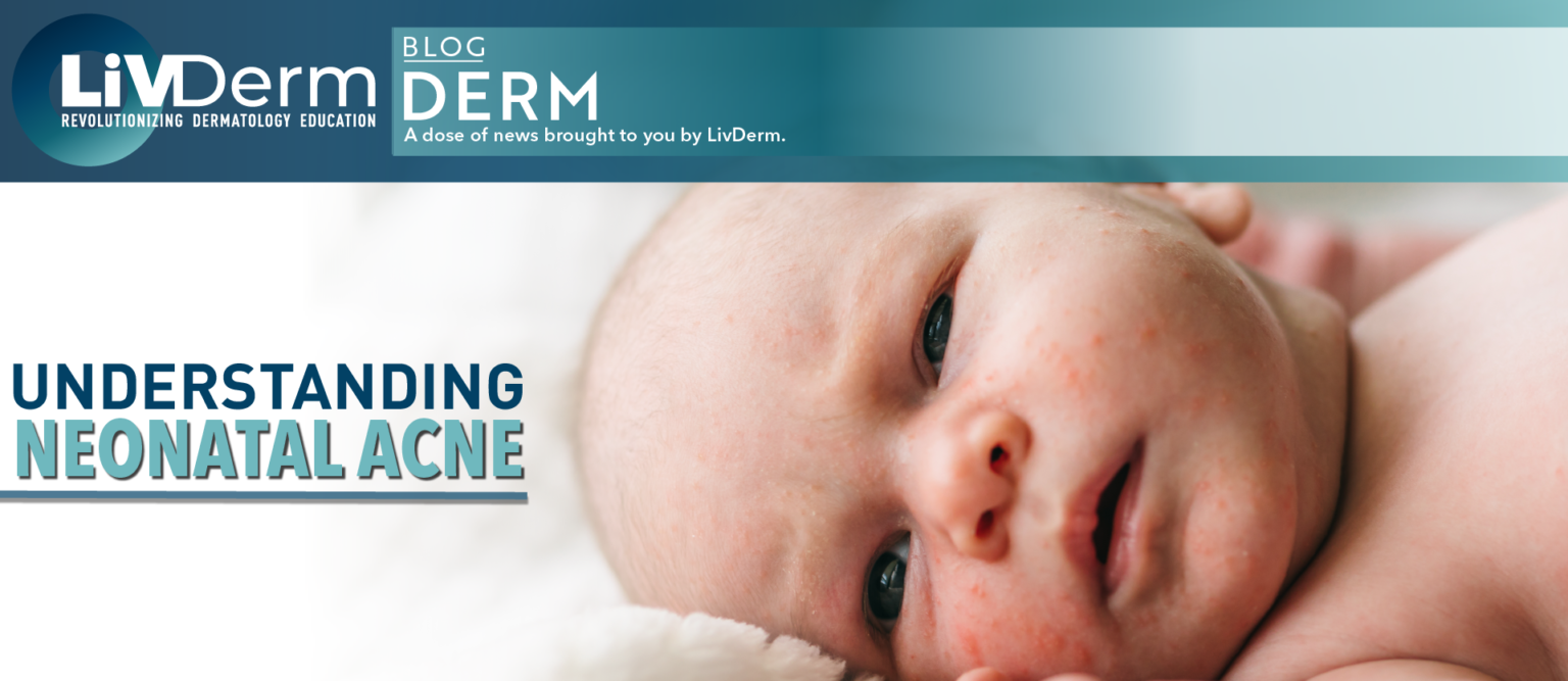 Understanding Neonatal Acne - LiVDerm