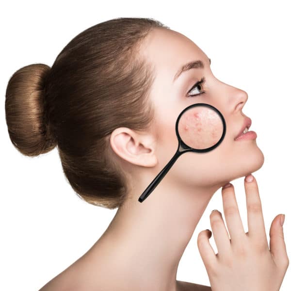 The Rise in Adult Female Acne - LiVDerm