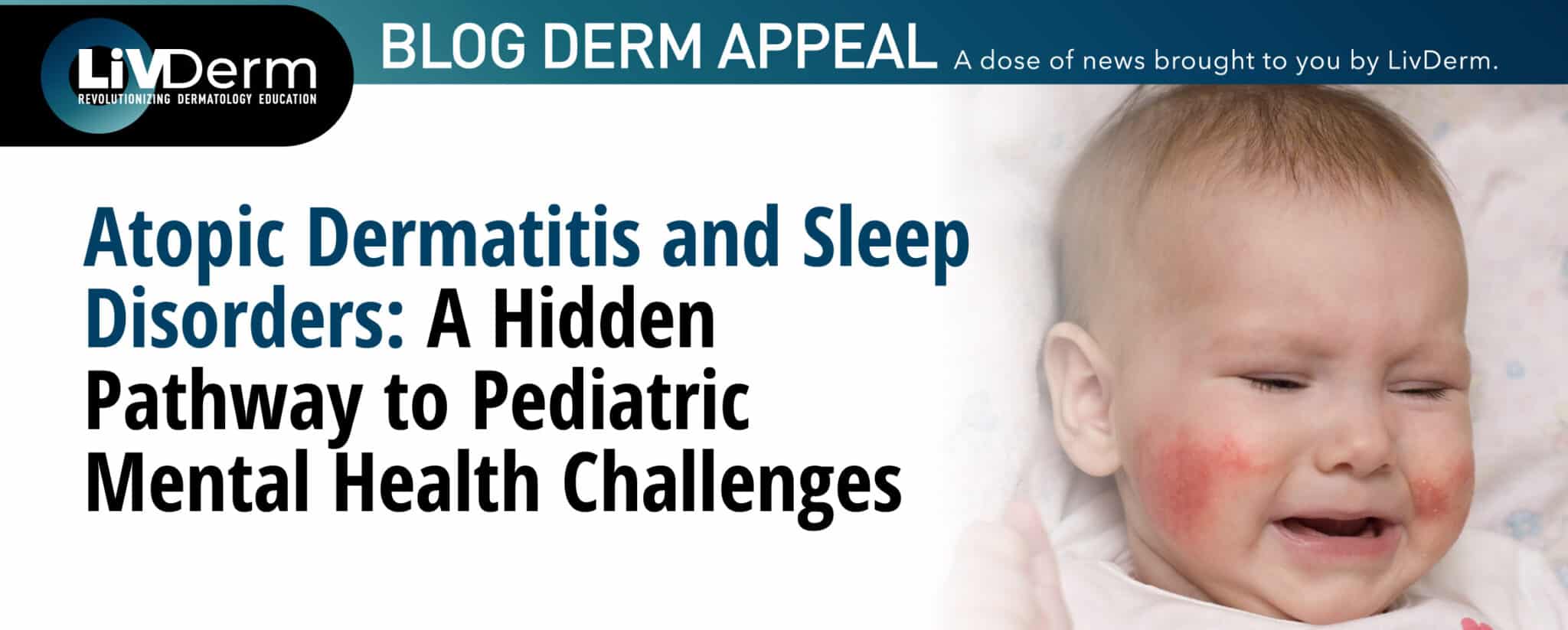 Atopic Dermatitis and Sleep Disorders: A Hidden Pathway to Pediatric ...